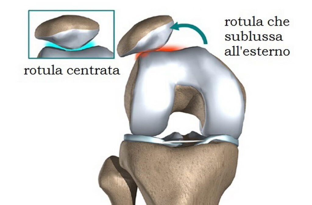 Sindorme da Iperpressione Rotulea Esterna o Displasia Femoro-Rotulea.