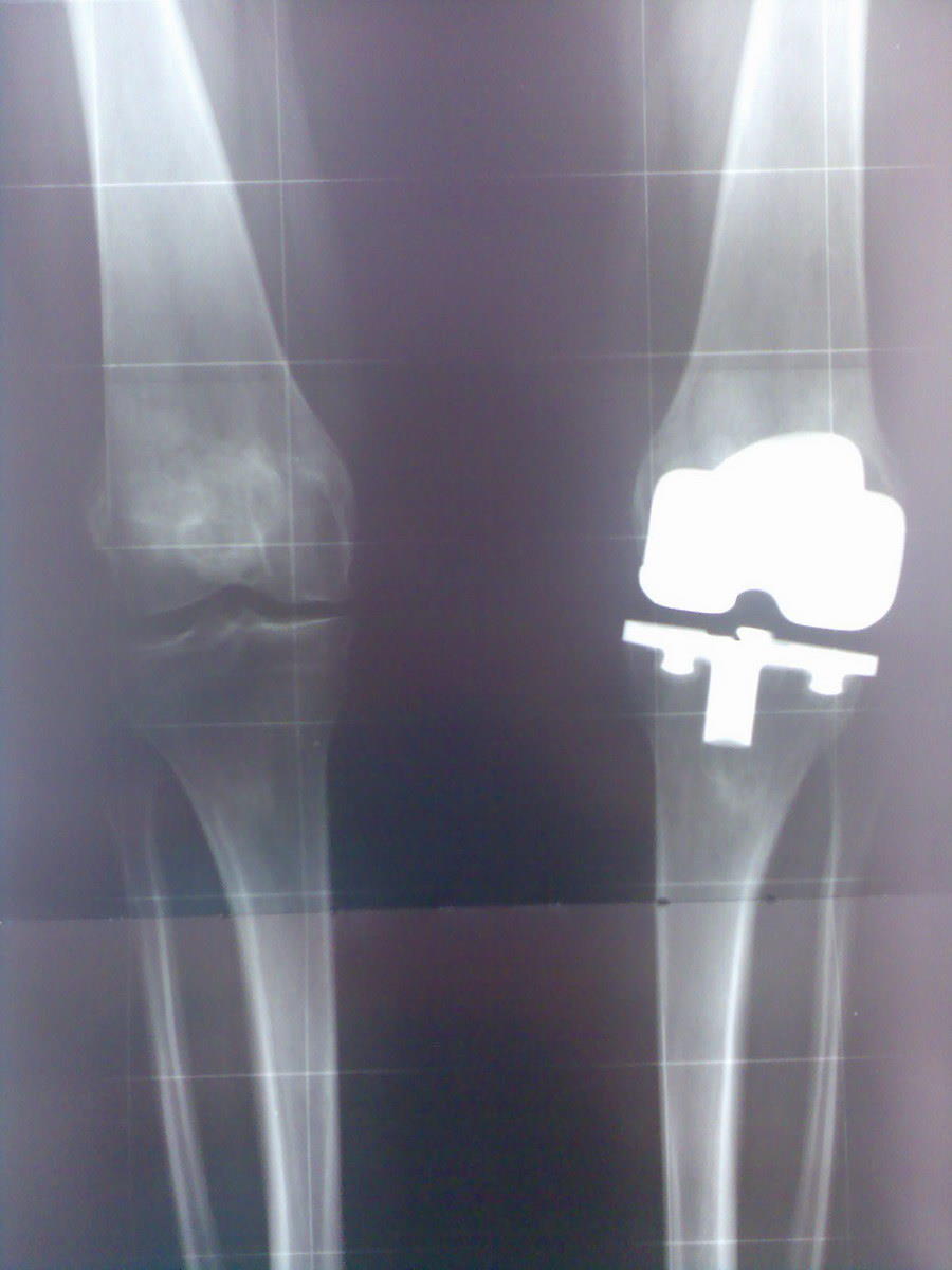 Intervento di Revisione nella Protesi di Ginocchio - Dott. Vinicio Perrone