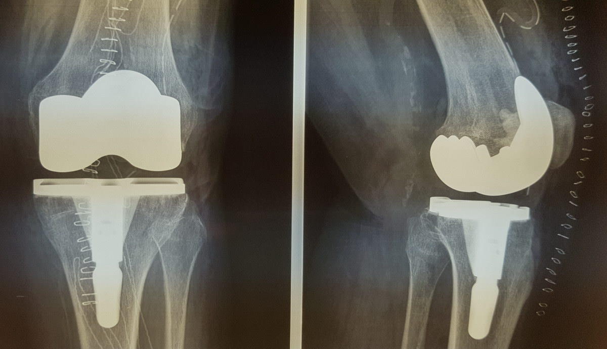 Intervento di Revisione nella Protesi di Ginocchio - Dott. Vinicio Perrone